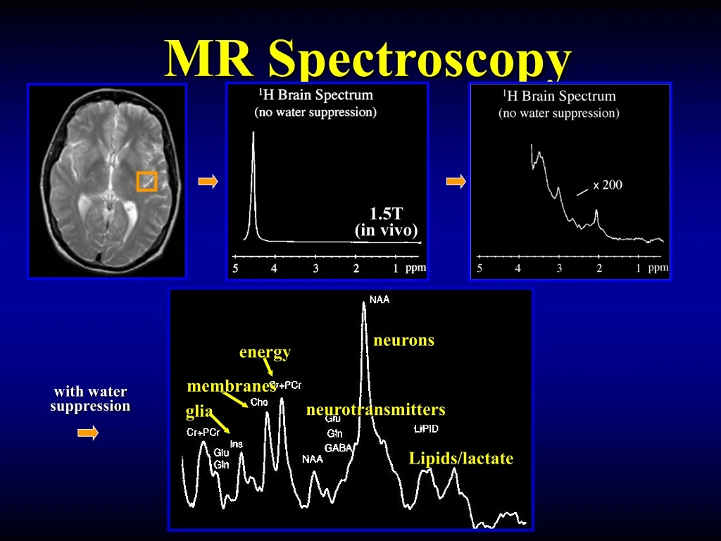 PPT - MR Spectroscopy PowerPoint Presentation, free download - ID:9184033