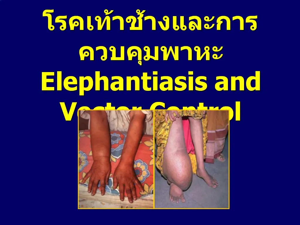 PPT - Elephantiasis and Vector Control PowerPoint Presentation, free ...
