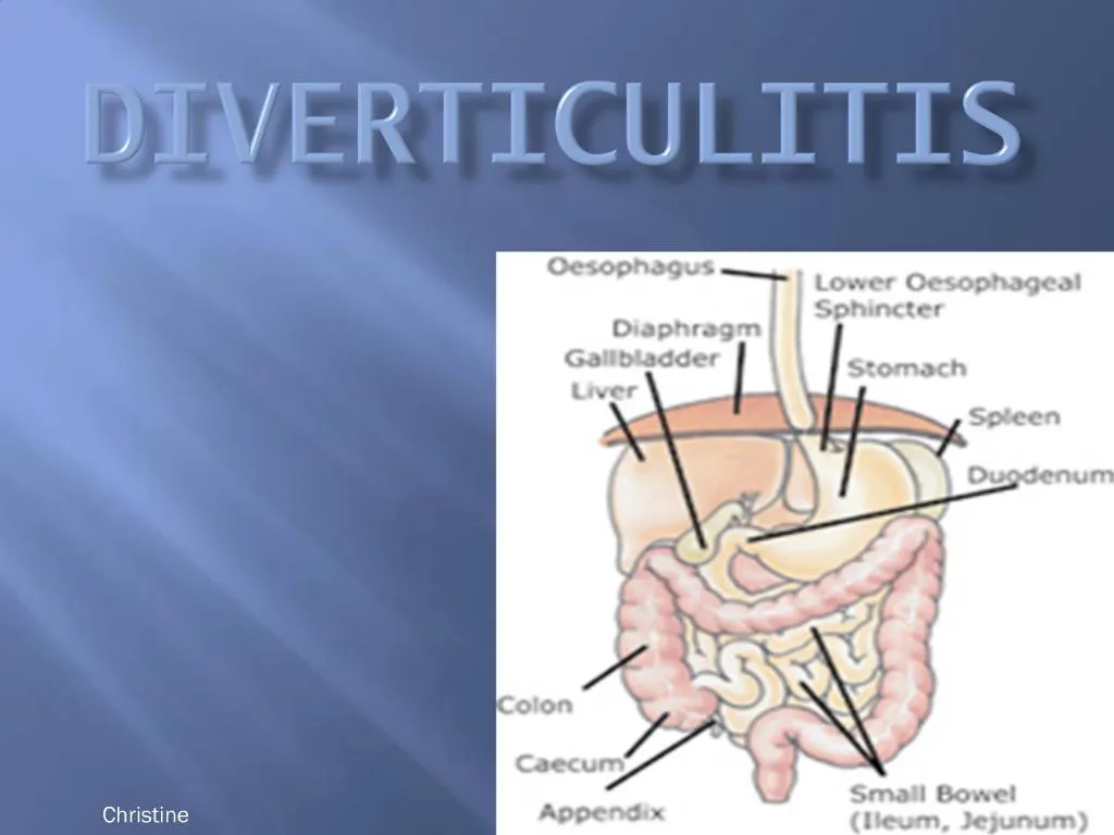 PPT - DIVERTICULITIS PowerPoint Presentation, free download - ID:965343