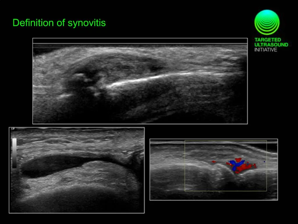 PPT - Definition of synovitis PowerPoint Presentation, free download ...